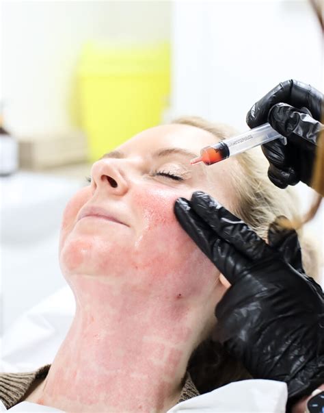 Iprf The Goldsmith Clinic