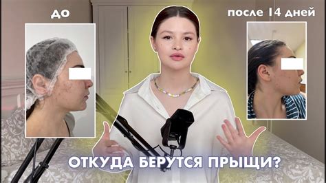 Ошибки в уходе за кожей ПОЧЕМУ ПОЯВЛЯЮТСЯ ПРЫЩИ Youtube