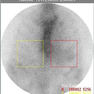 PDF Imaging Of Cardiac Amyloidosis By M Tc PYP Scintigraphy