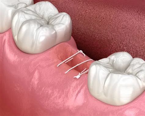 Wisdom Tooth Stitches Aftercare Tips Healing Time And More