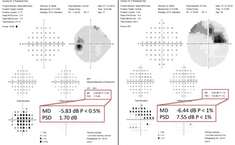 Field Testing Best Predictor Of Glaucoma Progression