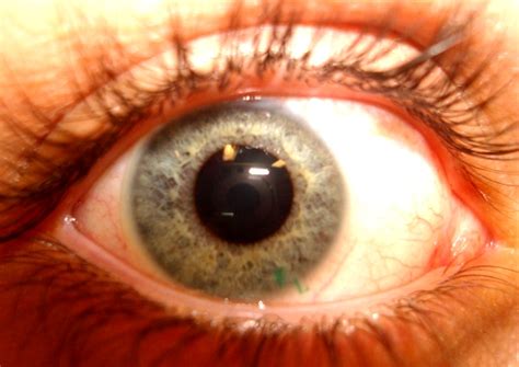 Drug Releasing Contact Lenses Created Softpedia