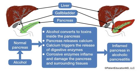 Alcoholic Pancreatitis Patienteducationmd