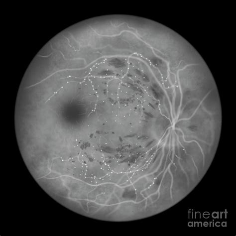 Retina Damage From Diabetes 46 By Science Photo Library