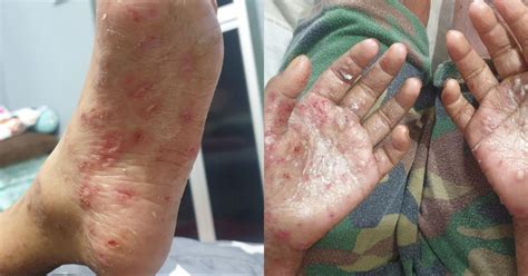 ‘the Pain Was Unbearable Sporean Girl 9 Could Not Shower Without