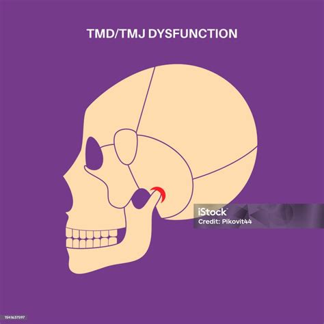 Tmd Tmj Disorder Stok Vektör Sanatı And Acı‘nin Daha Fazla Görseli Acı Ameliyat Anatomi Istock
