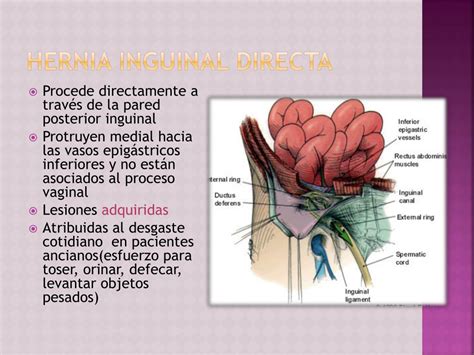 Inguinal Hernia