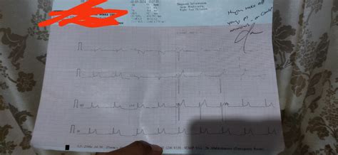 Right Axis Deviation Rreadmyecg