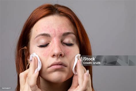 화장을 지우는 여자의 얼굴 과민증과 알레르기로 인해 빨간색 사람 얼굴에 대한 스톡 사진 및 기타 이미지 사람 얼굴 피부 알레르기 Istock