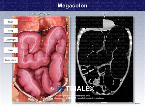 Megacolon Trialquest Inc