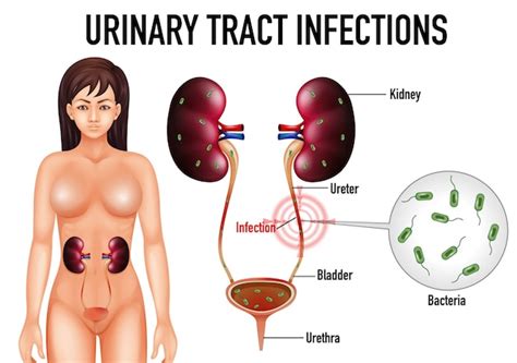 Free Vector Informative Illustration Of Urinary Tract Infections