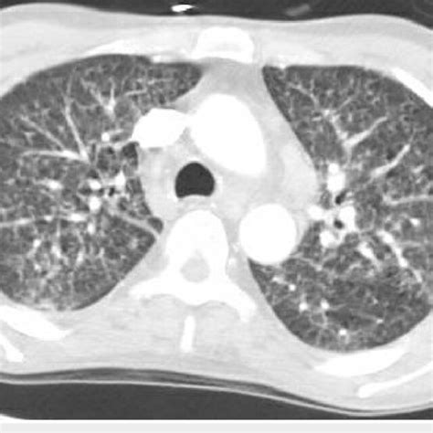 Reticulonodular Opacities Shown In Ct Of The Chest Download Scientific Diagram