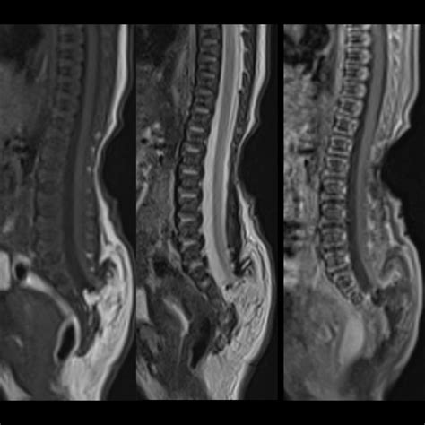 Newborn With A Skin Covered Bump On The Back Pediatric Radiology Case