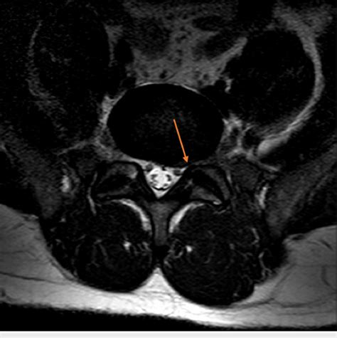 Mri Of The Lumbar Spine Showed Degenerative Retrolisthesis Of L5 On S1