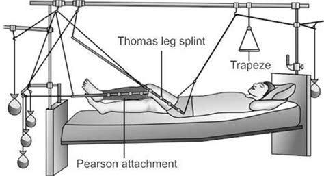 Balanced Suspension Skeletal Traction In Place