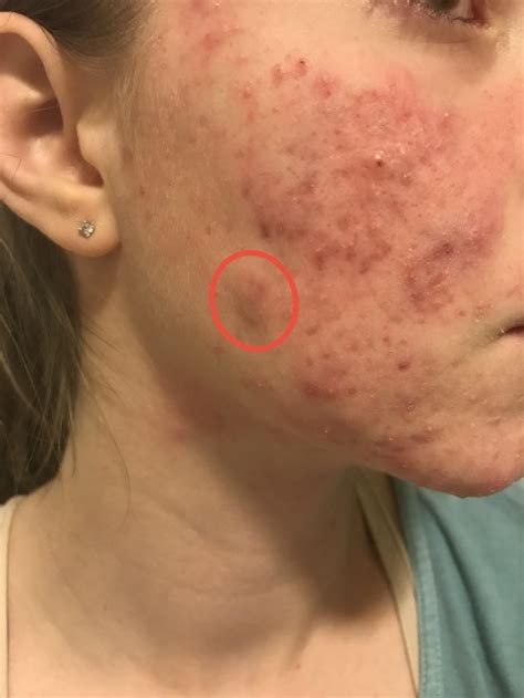 Is This Deep Cystic Acne Dry Itchy Skin And Nothing Has Worked So