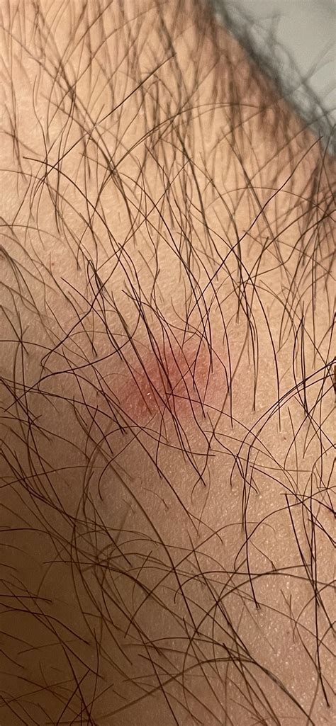 Red Scaly Patch On Skin Rmedicaladvice