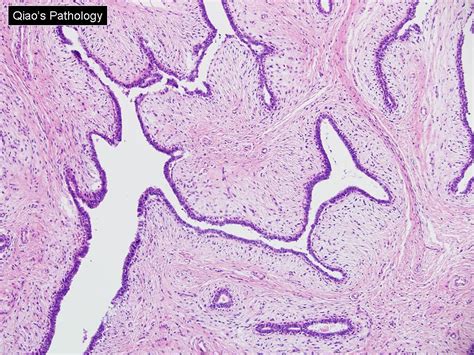 Qiaos Pathology Juvenile Fibroadenoma Of Breast（乔氏病理学：青少 Flickr