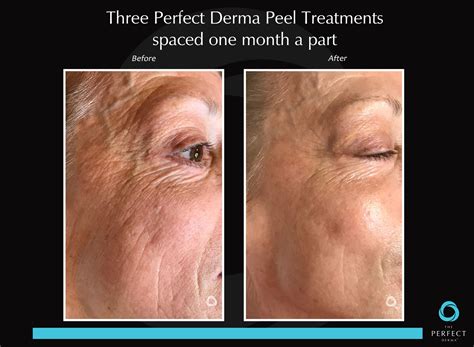 The Perfect Derma Peel In Mission Valley Ca Confident Complexion