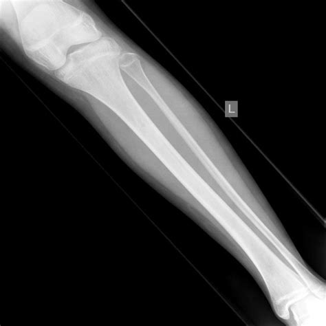 Bone V2 Subtype Instance Segmentation Dataset By Hello World