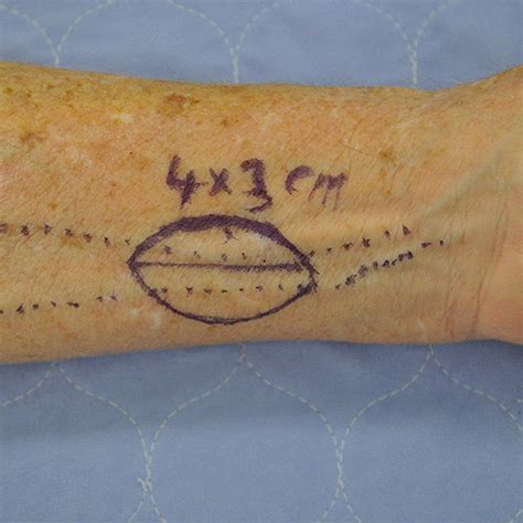 Preoperative Mapping Of The Venous Network And Initial AVF Design In Download Scientific