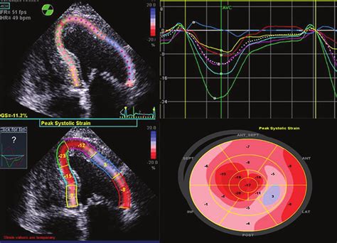 Ste In A Patient With Cardiac Amyloidosis Shows Decreased Global