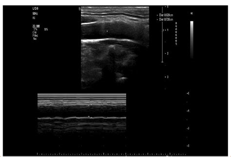 Systolic Diastolic Diameter Measurements Download Scientific Diagram