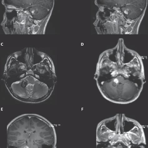 Avm Classification By Yakes Et Al 9 Download Scientific Diagram