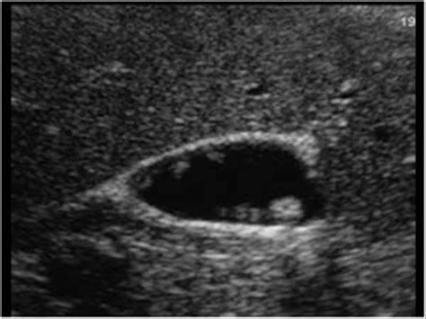 Abdomen And Retroperitoneum 12 Gallbladder And Bile Ducts Case 12