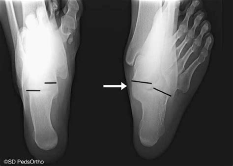 X Ray Calcaneus Ap View Positioning At Alana Tebbutt Blog