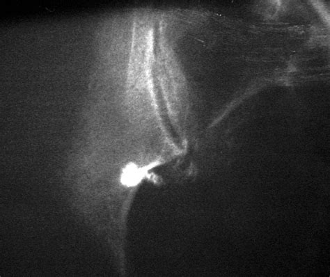 Appendix Fecalith 1362 Appendicitis Barium 1 Surgery Photos