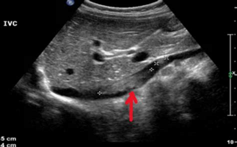 Wilms Tumour Nephroblastoma British Association Of Paediatric Surgeons