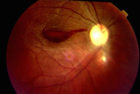 Retinography Of The Right Fundus Shows A Preretinal Hemorrhage At The Download Scientific