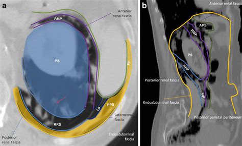 Sigmoid Perforation During Colonoscopy With Polyp Excision In A Download Scientific Diagram