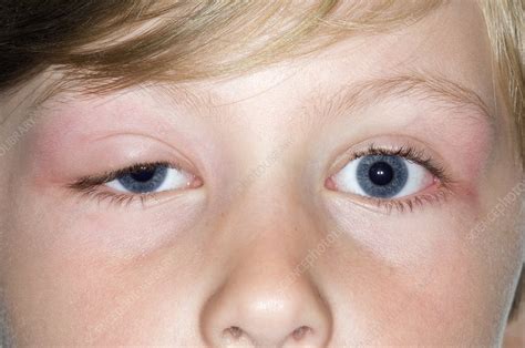 Mosquito Bite Near Eye At Loretta Little Blog