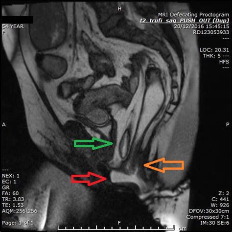Sigmoidocele Green Arrow Intrarectal Intussusception Orange Arrow