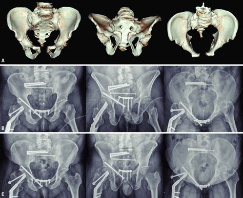 A Year Old Male Suffered From An Anterior Posterior Compression Type Download Scientific