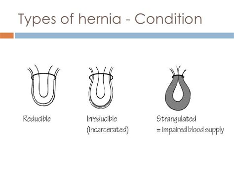 Laparoscopic Hernia Surgery In Mumbai Hernia Repair