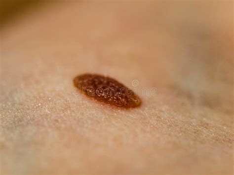Closeup Brown Mole On Skin Stock Image Image Of Cancer 351652909