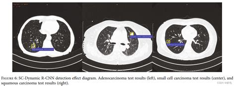 论文翻译：sc Dynamic R Cnn A Self Calibrated Dynamic R Cnn Model For Lung Cancer Lesion Detection