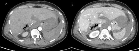 Hepatic Abscess In Resected Hepatocellular Carcinoma On Vi Hepatic Download Scientific Diagram