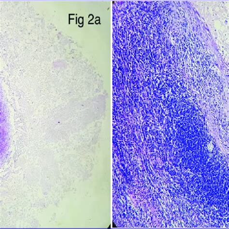 A Cyst Wall Lined By Squamous Epithelium With Lymphoid Tissue In