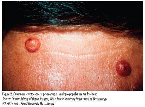 Cryptococcus Skin
