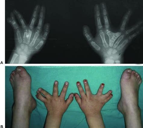 Metacarpal Synostosis Duplicated And Tightly Fused Symmetrically Bifid Metacarpal Bone