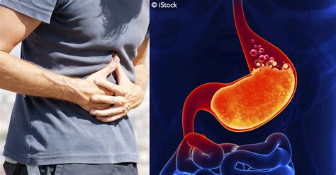 Acidez Estomacal ¿qué Es Y Cómo Tratarla Va A Gustarme