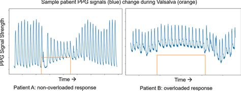 Sample Ppg Signal Blue Data From Two Representative Patients In Download Scientific Diagram
