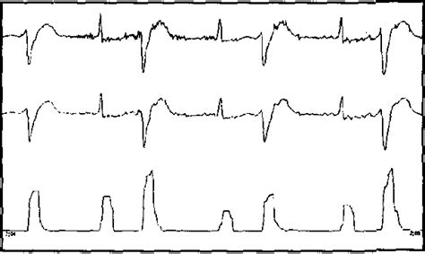 Figure 4 From A Robust Open Source Algorithm To Detect Onset And