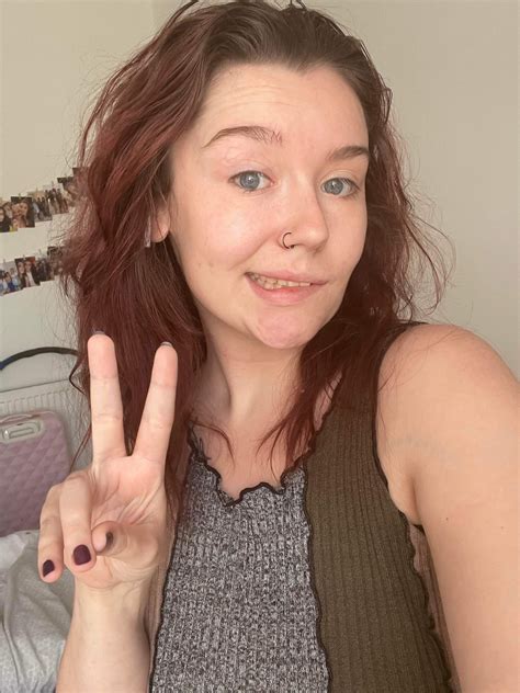 Mollys Story Facial Palsy Uk