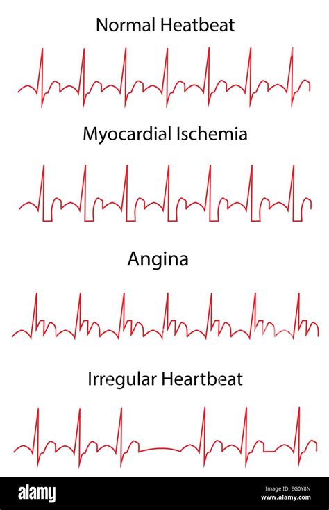 Echocardiogram Vs Ekg Explained By A Cardiologist Myheart What Do My