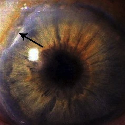 Secondarily Acquired Nasolacrimal Duct Obstruction Resulting From